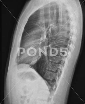 Chest X-Ray lateral view Normal digital radiography of a male chest in ...