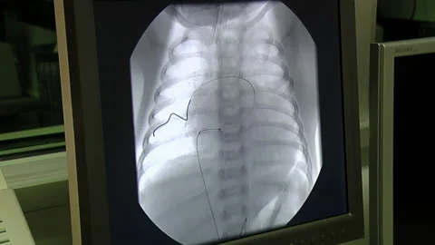 Chest X Ray Stock Footage ~ Royalty Free Stock Videos | Pond5