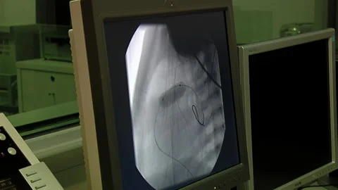 A Chest X Ray of a Patient on Monitor Du... | Stock Video | Pond5