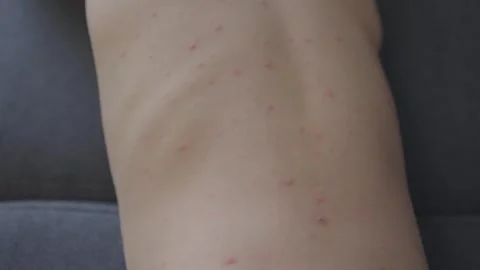 chickenpox rash blisters filled liquid o... | Stock Video | Pond5