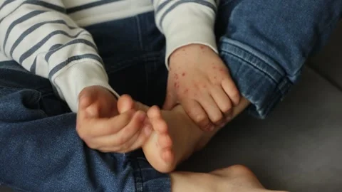 Child with skin rash, roseola, Hand-foot... | Stock Video | Pond5