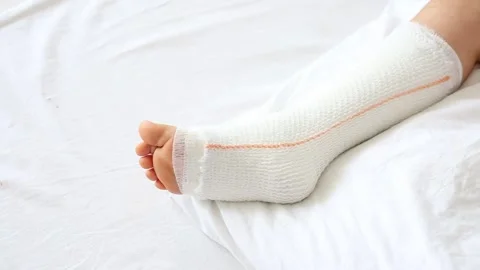Children's broken leg in orthopedic cast... | Stock Video | Pond5