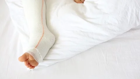 Children's broken leg in orthopedic cast... | Stock Video | Pond5