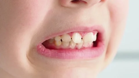 Children's teeth are large. Wide open mo... | Stock Video | Pond5