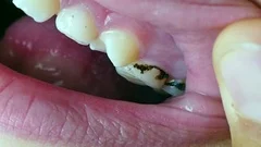 Black Calculus Teeth