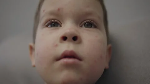 Chilld boy face marked with red spots fr... | Stock Video | Pond5