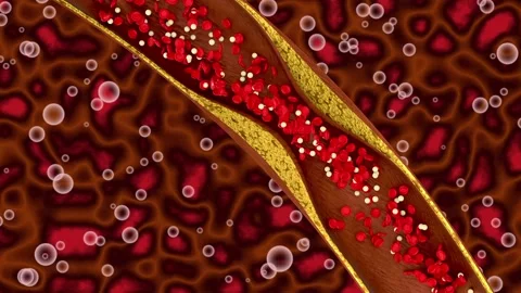 Cholesterol block blood cell in artery v... | Stock Video | Pond5