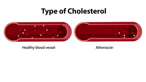 Cholesterol Types and Blood Vessel Healt... | Stock Video | Pond5