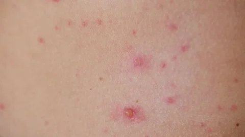 The classic symptom of chickenpox is a r... | Stock Video | Pond5
