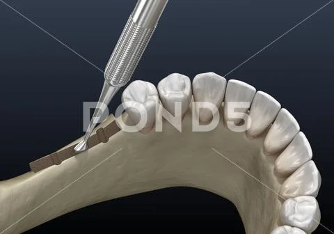 Cleavage of the alveolar ridge, augmentation. Dental surgery, 3D ...