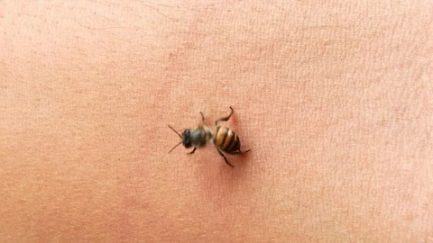 Close up of the bee sting in human skin ... | Stock Video | Pond5