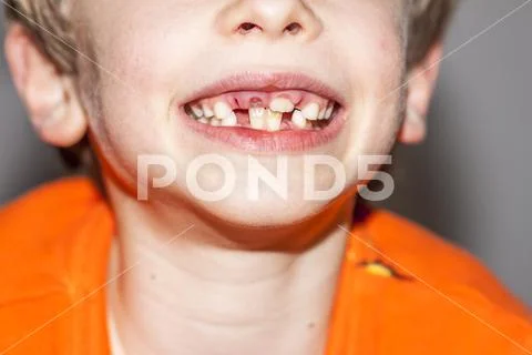 Close-up of child of eight years with the problem of not loosing his ...