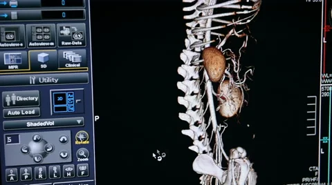 close up of CT scan computer | Stock Video | Pond5