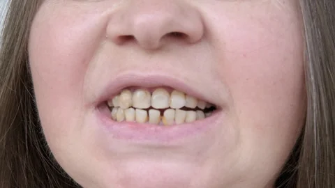 close-up of Curved teeth with yellow dep... | Stock Video | Pond5