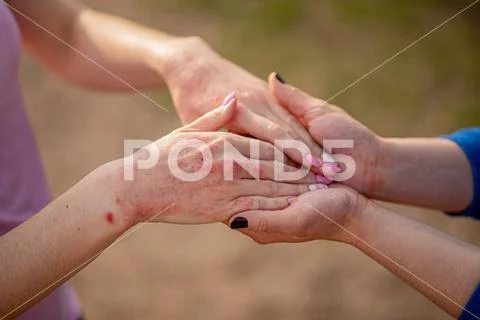 Close up dermatitis on skin, ill allergic rash eczema skin of patient ...