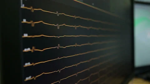 Close-up of ECG monitor in hospital. | Stock Video | Pond5