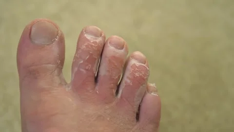 Close-up of the foot with fungal disease... | Stock Video | Pond5
