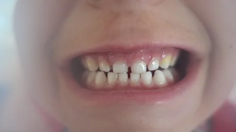 Close up front milk teeth of a child | Stock Video | Pond5