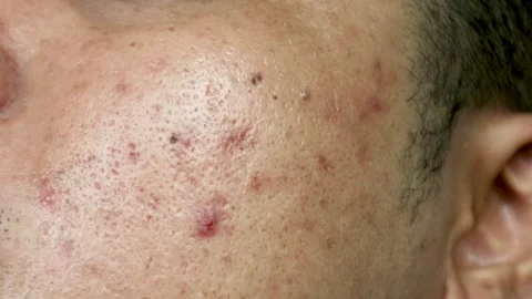 Close up of Inflamed acne problem on Asi... | Stock Video | Pond5