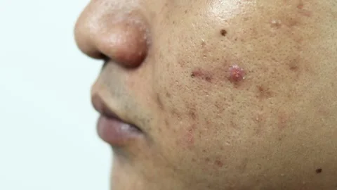 Close up of Inflamed acne problem on Asi... | Stock Video | Pond5