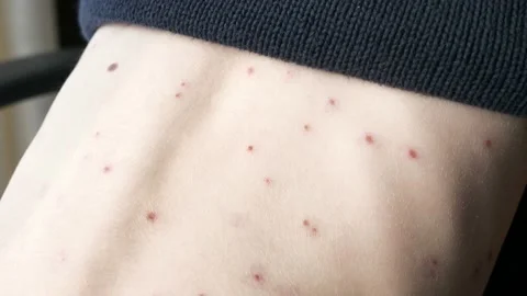 Close-up Kid Back with Rash of Itchy Inf... | Stock Video | Pond5