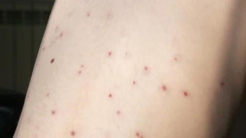 Close-up Kid Back with Rash of Itchy Inf... | Stock Video | Pond5