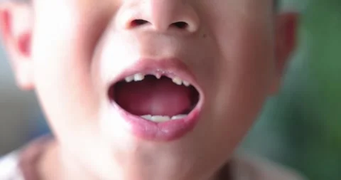 Close up of kid smiling with missing fro... | Stock Video | Pond5