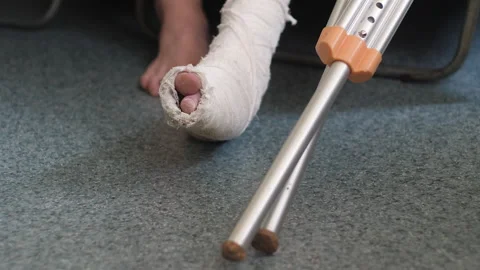 close-up of the leg in a cast of a man a... | Stock Video | Pond5