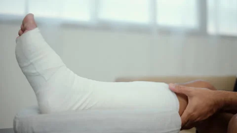 Close-up leg splints in cast of man suff... | Stock Video | Pond5