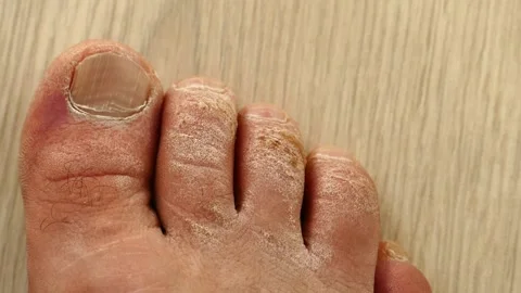 close-up of a man's toes with fungal dis... | Stock Video | Pond5