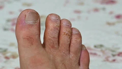 close-up of a man's toes with fungal dis... | Stock Video | Pond5
