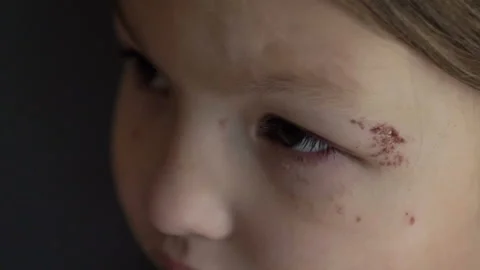 Close-up of a painful wound near the eye... | Stock Video | Pond5