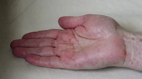 Close up of rash on the arm | Stock Video | Pond5