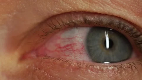 Close-up of red eye showing conjunctivit... | Stock Video | Pond5
