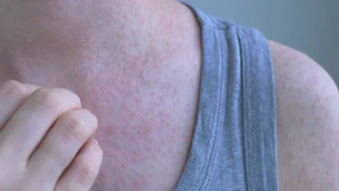 Close-up shot of an allergic rash in the... | Stock Video | Pond5