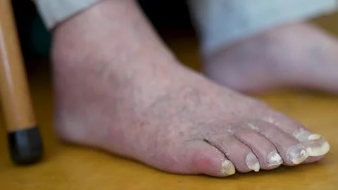 Close-up shot of an elderly person foot ... | Stock Video | Pond5