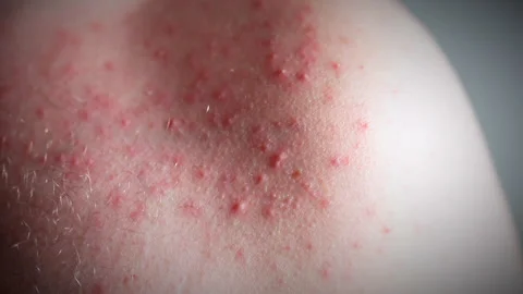 Close-up shot of skin rashes and pimples... | Stock Video | Pond5