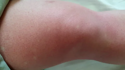 Close up Skin of Dengue fever patient bl... | Stock Video | Pond5