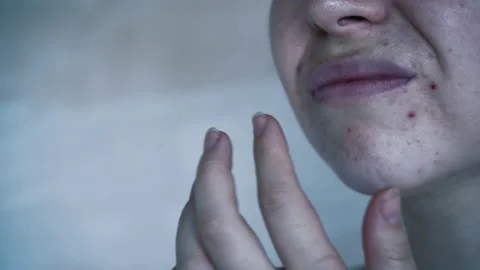 Unhealthy Skin Stock Video Footage | Royalty Free Unhealthy Skin Videos ...