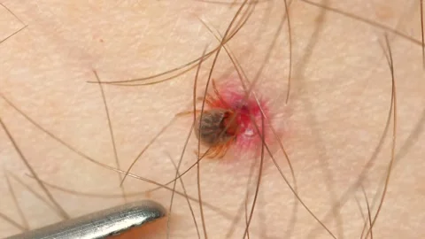 Close Up Of Tick Biting Human Skin Remo Stock Video Pond5