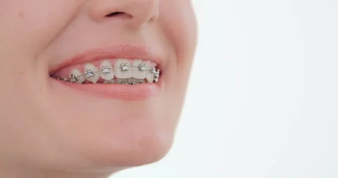 Brace Braces Stock Videos – Royalty-Free HD & 4K Videos | Pond5