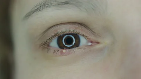 Stye Eye Stock Video Footage | Royalty Free Stye Eye Videos | Pond5