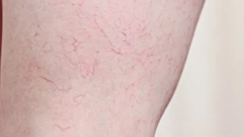 Close-up of woman's leg with red rash an... | Stock Video | Pond5