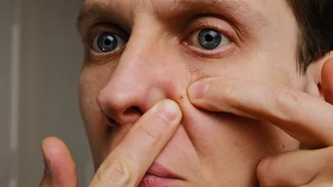 Pimple Popping On Stock Videos – Royalty-Free HD & 4K Videos
