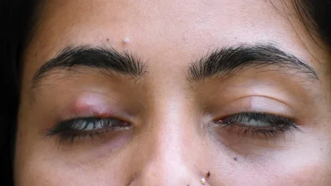 Stye Eye Stock Videos – Royalty-Free HD & 4K Videos