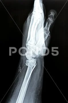 Colles' fracture of an old female, a type of fracture of the distal ...