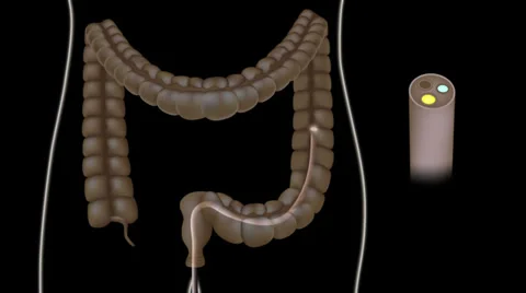 Colonoscopy Procedure Showing Stock Footage ~ Royalty Free Stock Videos ...