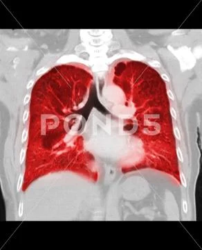 Compare CT scan of Chest axial view of normal lung and lung infection ...