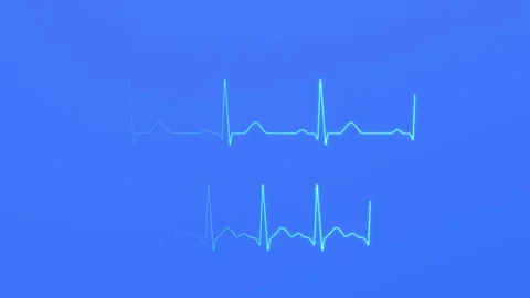 Comparison of ECG of normal heart rhythm... | Stock Video | Pond5