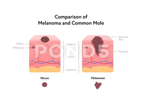 Comparison of tumor and common mole with text.: Royalty Free #154635610
